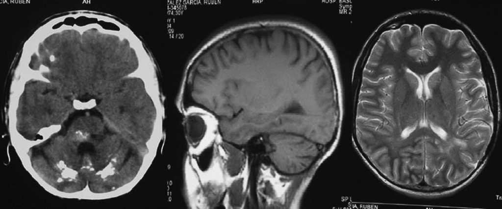 Calcificaciones intracraneales. Imagen por RM | Radiología