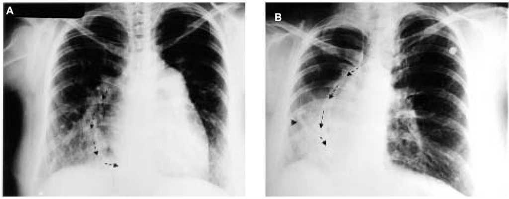 Clinical and Echocardiographic Characteristics of Scimitar Syndrome ...