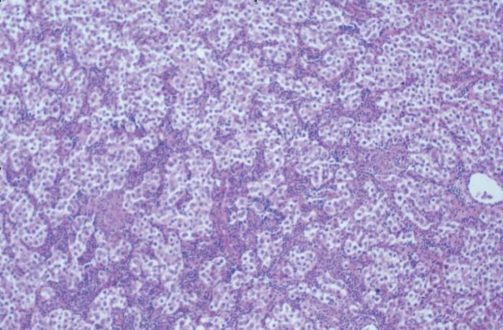 Tumores de células germinales del ovario: disgerminoma y gonadoblastoma ...