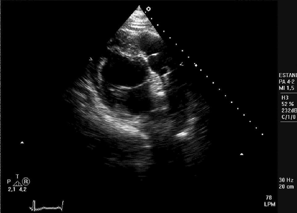 Infective Endarteritis in Patent Ductus Arteriosus and Septic Pulmonary ...