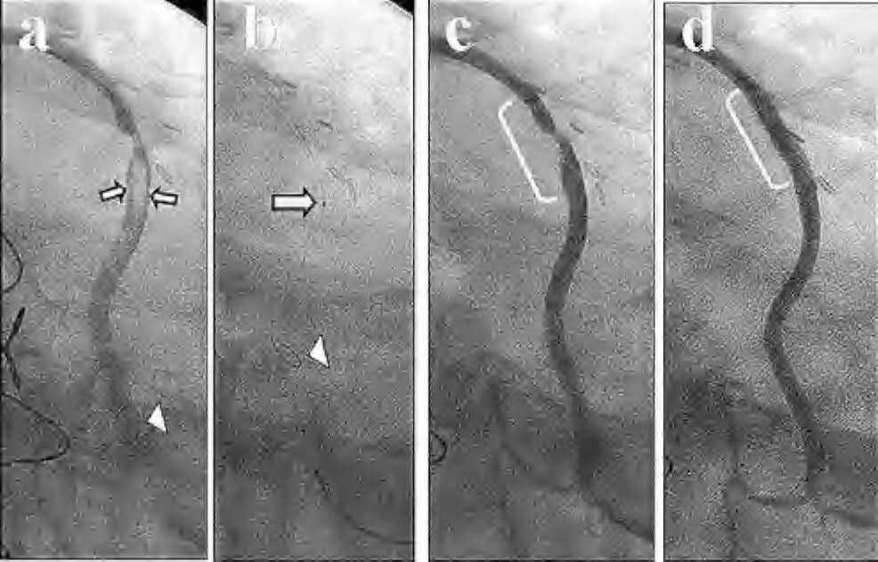 Combined Distal Protection and Thrombectomy in a Saphenous Vein Bypass ...