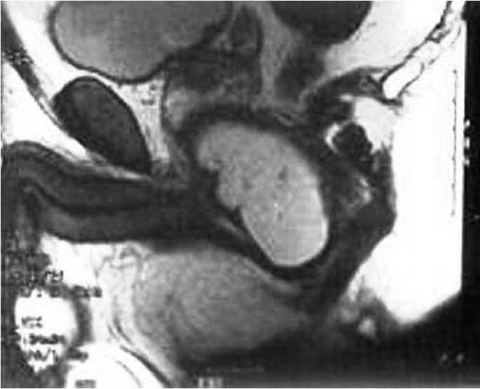 Lipoma fusocelular de localización perineal | Cirugía Española