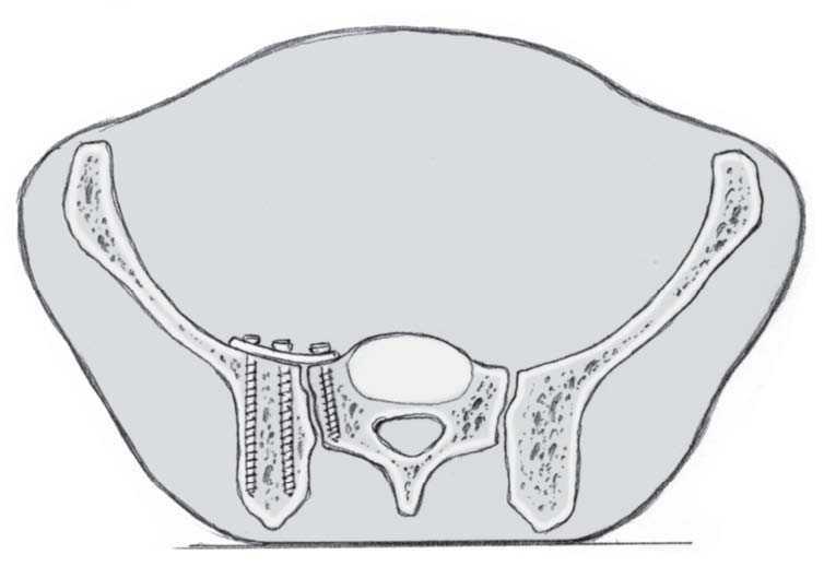 Fijación interna de la articulación sacroilíaca | Técnicas Quirúrgicas ...