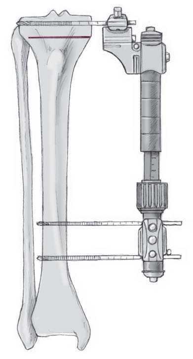 Osteotomía valguizante proximal de tibia con distracción del callo ...