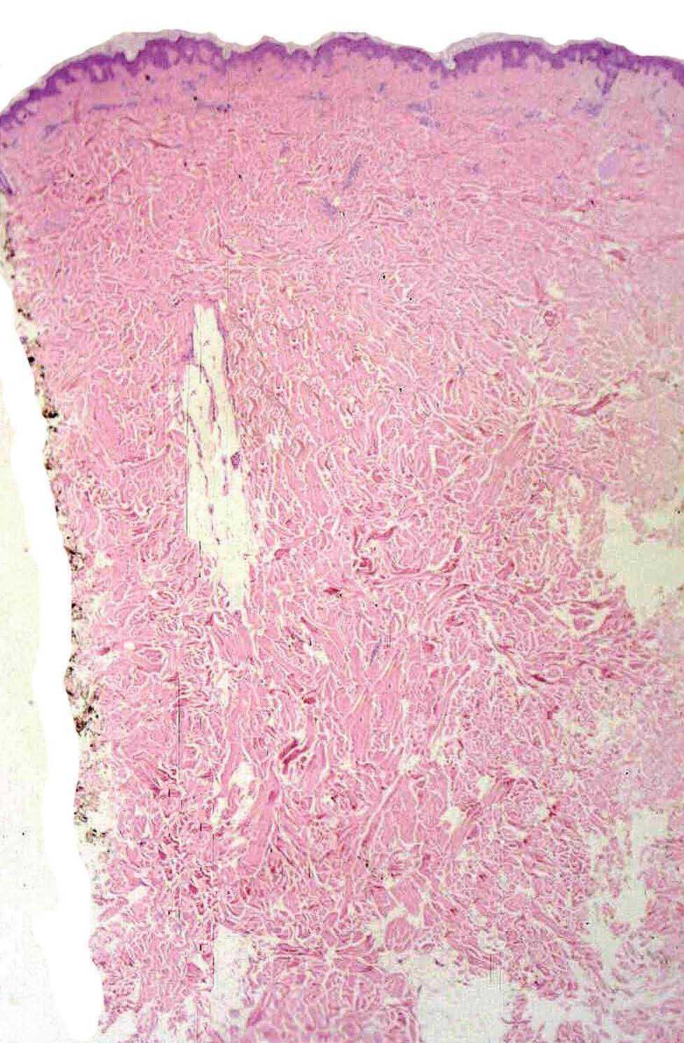 Escleredema | Actas Dermo-Sifiliográficas
