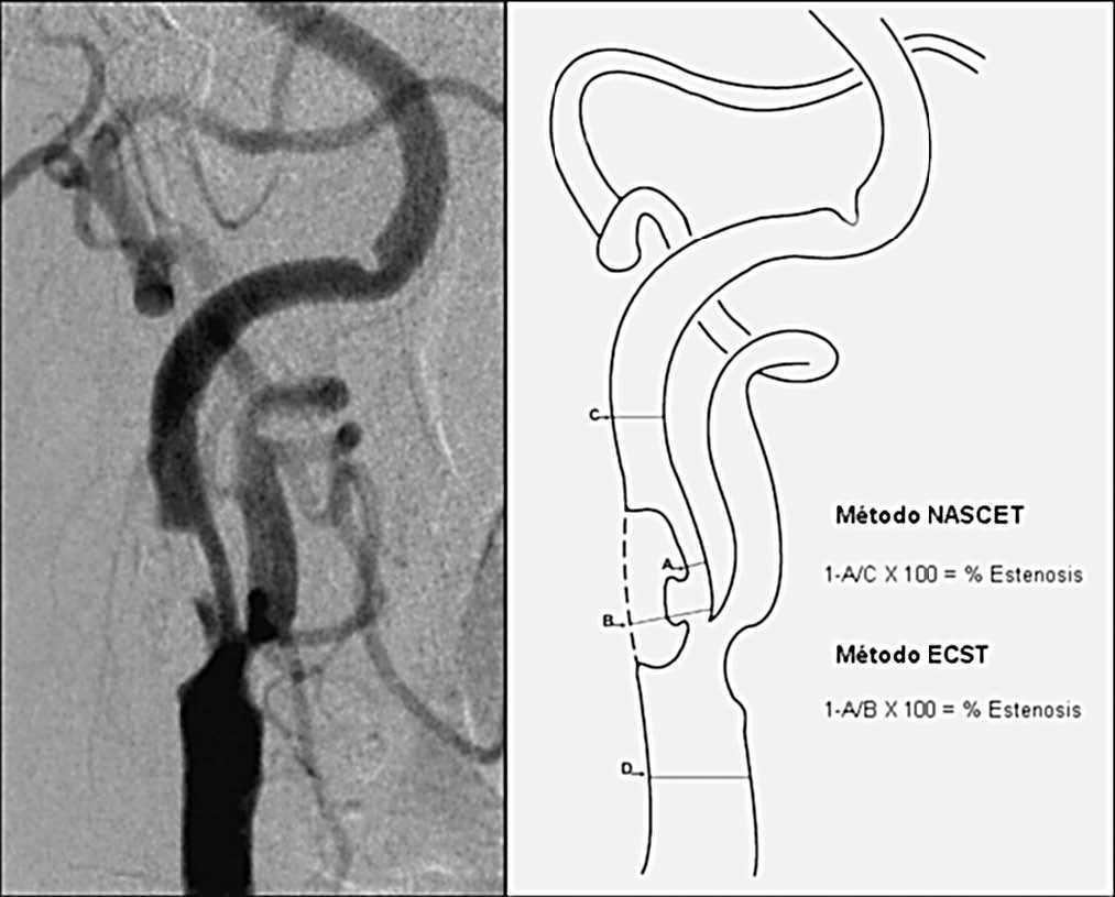 Estenosis carotídea: cómo se diagnostica y se trata adecuadamente ...