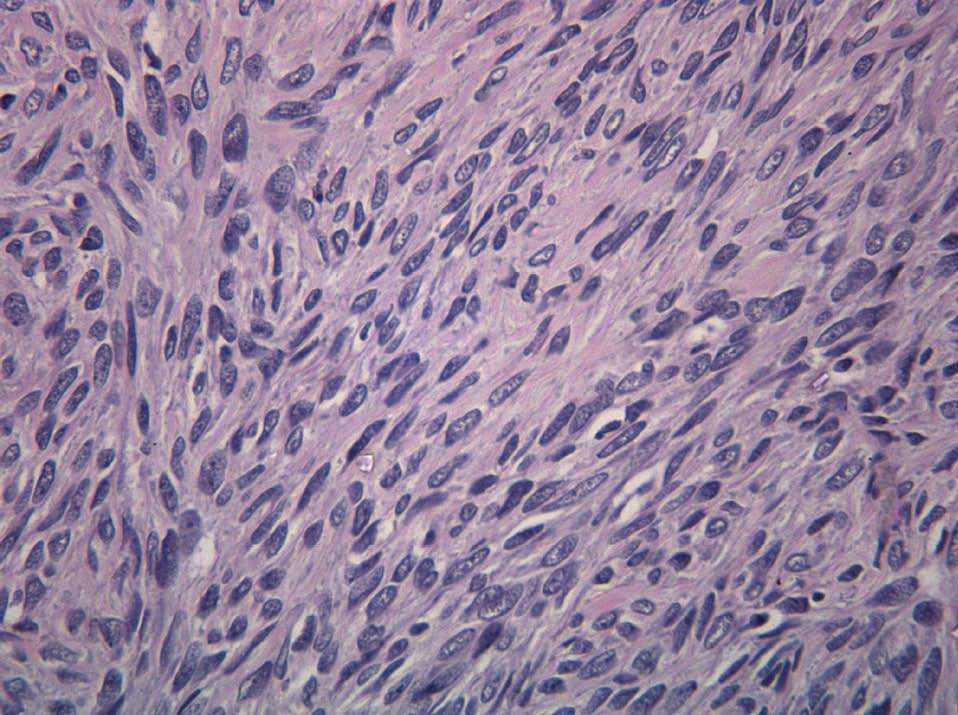Fibroma ovárico torsionado | Progresos de Obstetricia y Ginecología