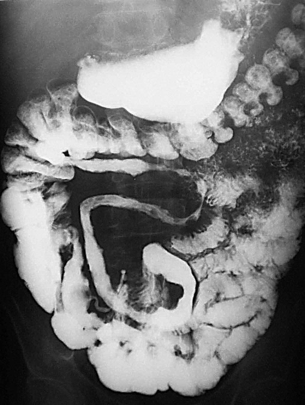 Diagnóstico por imagen en la enfermedad inflamatoria intestinal ...