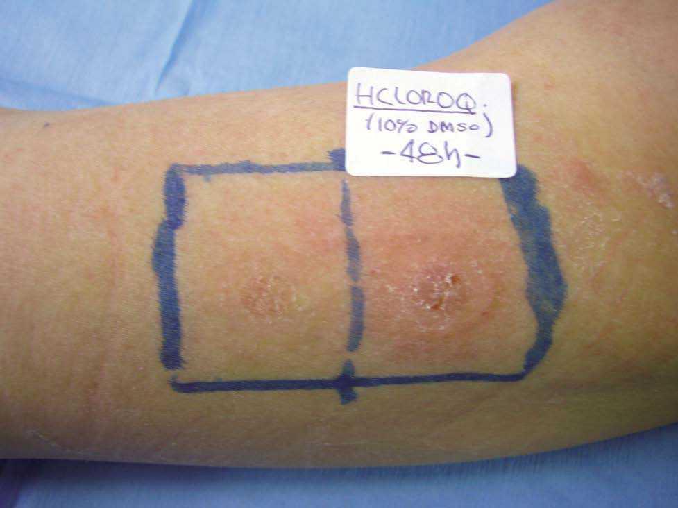 Delayed hypersensitivity to hydroxychloroquine manifested by two ...