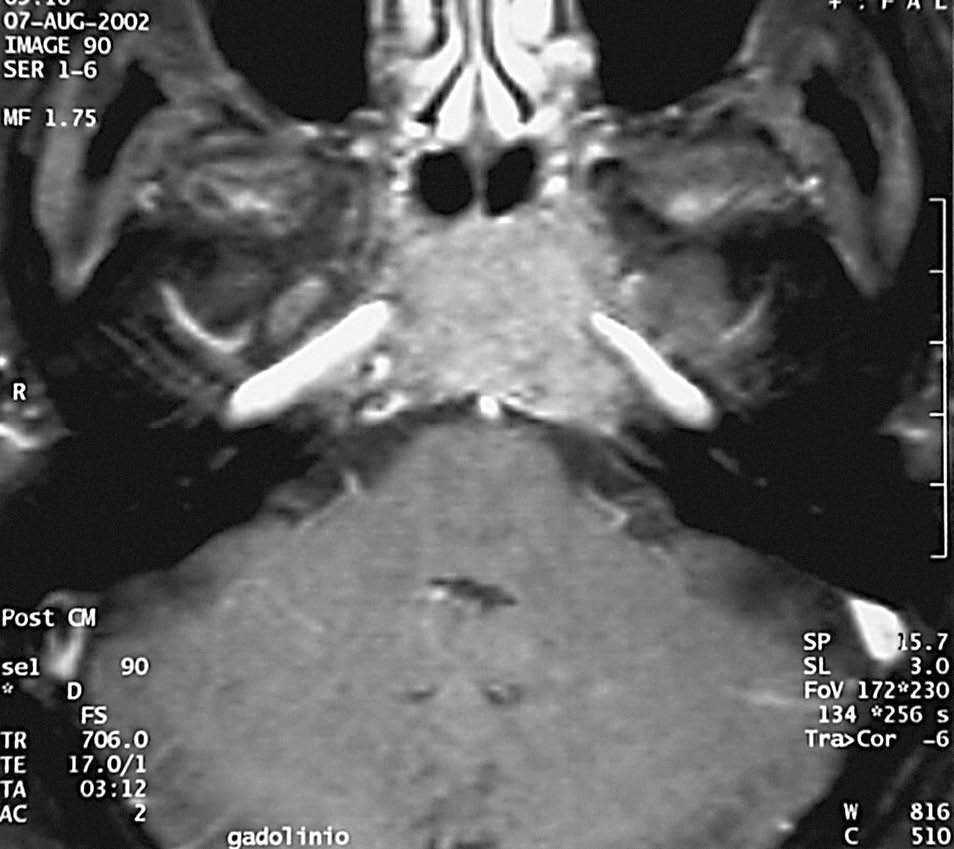 Metástasis en clivus de hepatocarcinoma asociado a quimiembolización ...