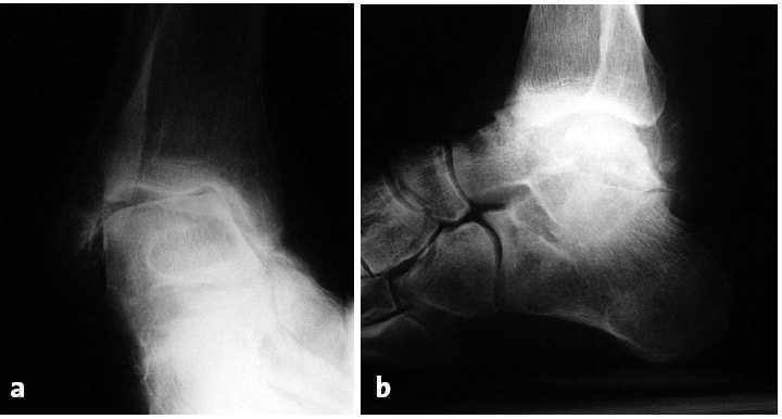 Abordaje transfibular para artrodesis de tobillo | Técnicas Quirúrgicas ...