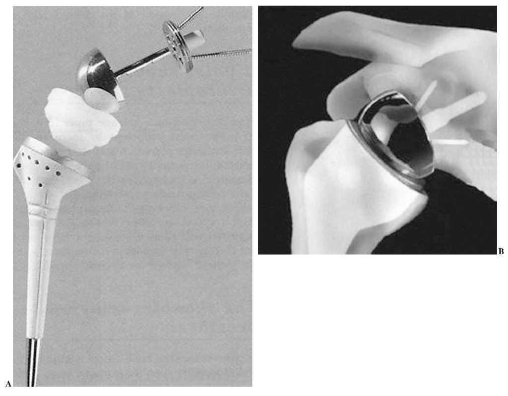 Prótesis de hombro «KIMS». Estudio experimental | Revista Española de ...