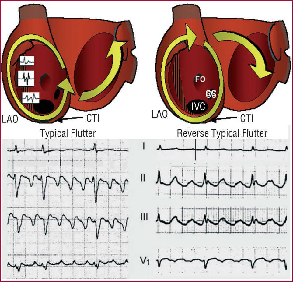 20 Best Atrial Flutter Images Atrial Flutter Flutter Conduction Images 20 Best Atrial Flutter Images Atrial Flutter Flutter Conduction Images