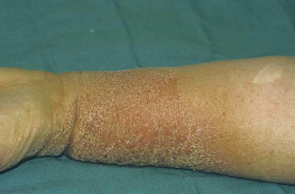Fotodermatitis de contacto por dexketoprofeno. Descripción de dos casos ...