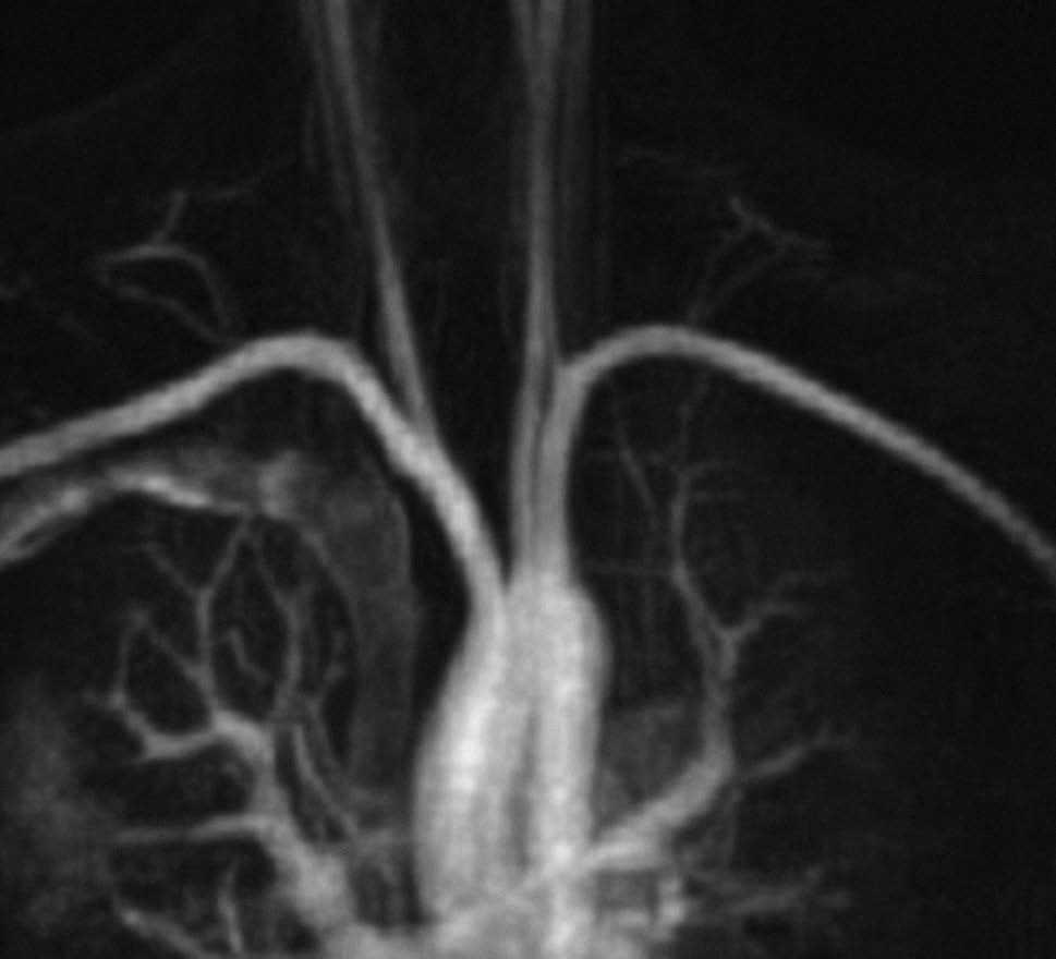 Diagnóstico por angiorresonancia magnética del síndrome del estrecho ...
