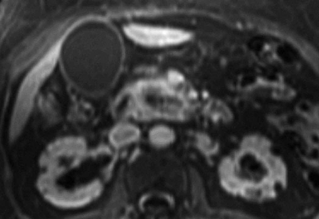 Diagnóstico y estadificación del carcinoma de páncreas (I) | Radiología