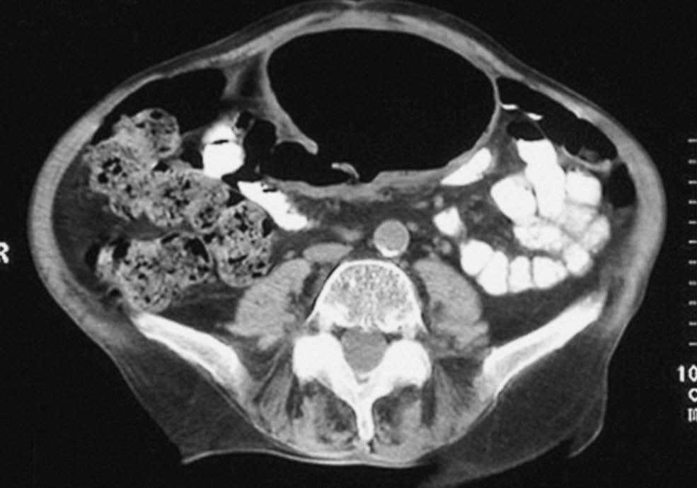 Divertículo gigante de colon | Radiología