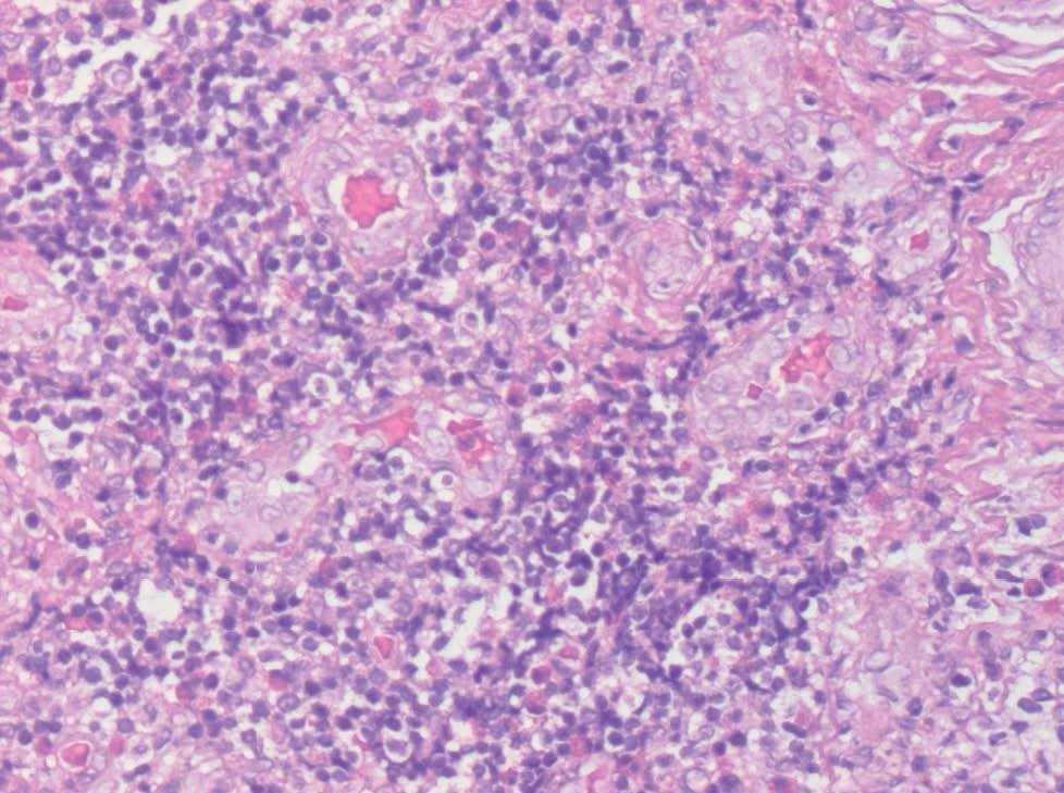 Nódulo asintomático en la frente | Actas Dermo-Sifiliográficas