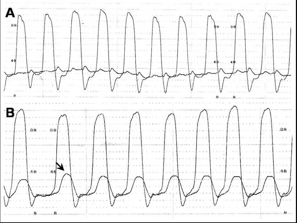 Paciente con pericarditis efusivo-constrictiva idiopática | Revista ...