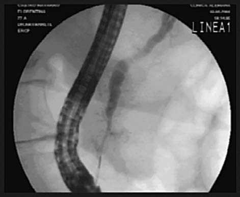 Esfinterotomía pancreática: cuándo y cómo | Gastroenterología y Hepatología