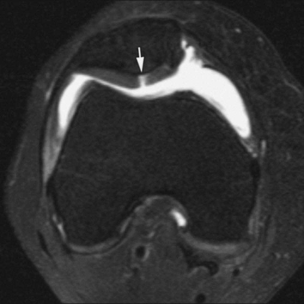 Técnica e indicaciones de la resonancia magnética artrografía ...