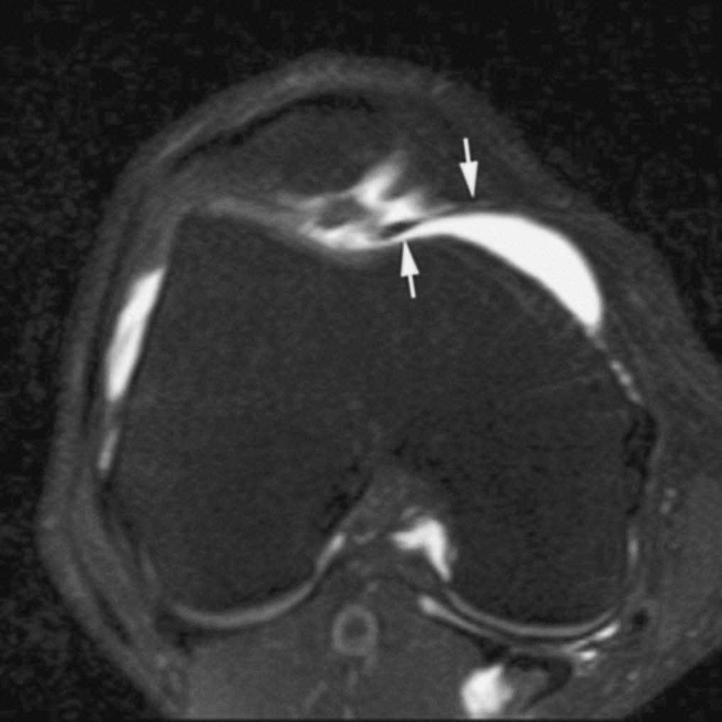 Técnica e indicaciones de la resonancia magnética artrografía ...
