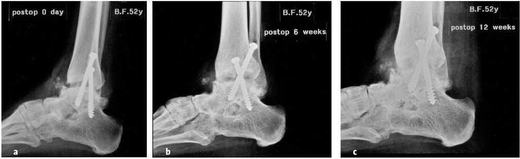 Artrodesis del tobillo usando técnica artroscópica | Técnicas ...