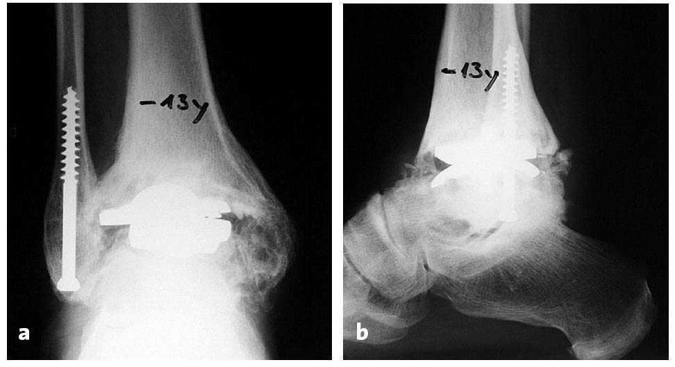 Artrodesis tras fallo de prótesis total de tobillo | Técnicas ...