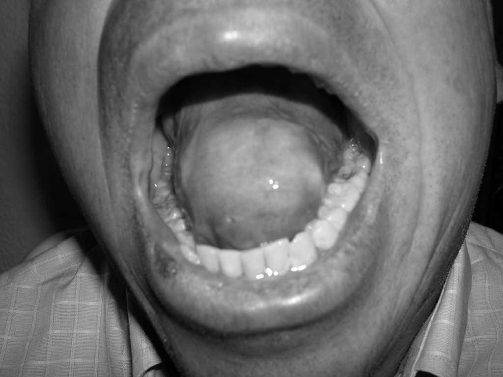 Quiste dermoide de suelo de boca | Acta Otorrinolaringológica Española