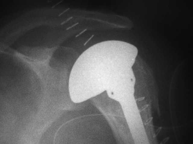 Influencia de la versión protésica y de la consolidación del troquíter ...