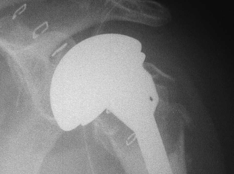 Influencia de la versión protésica y de la consolidación del troquíter ...