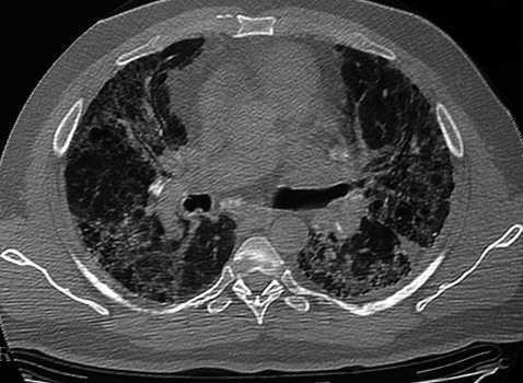 Trasplante pulmonar. Carcinoma broncogénico en pulmón nativo | Archivos ...