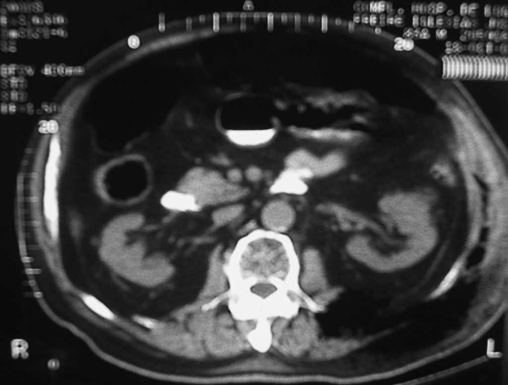 Mionecrosis por Clostridium como complicación de hernioplastia inguinal ...
