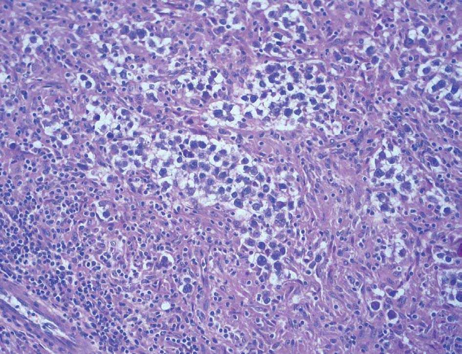 Actualización en el tratamiento del disgerminoma ovárico | Progresos de ...