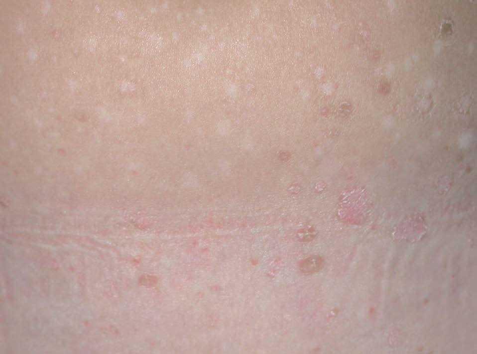 Pitiriasis liquenoide localizada | Actas Dermo-Sifiliográficas