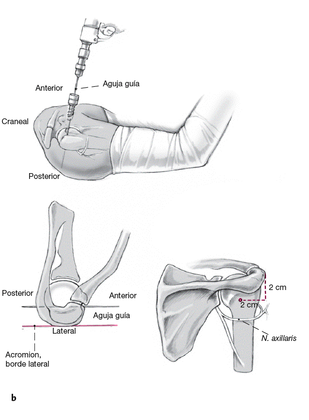 Tenodesis artroscópica de las lesiones de la porción larga del bíceps ...