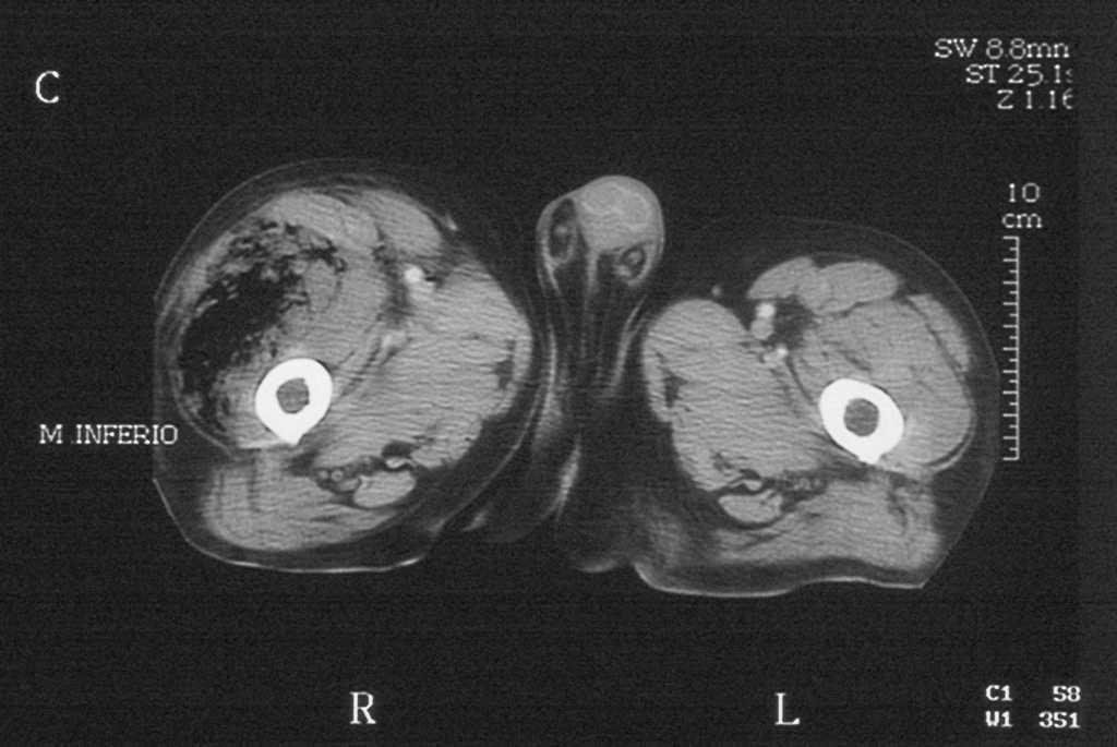 Mionecrosis de la extremidad inferior por Clostridium septicum en ...