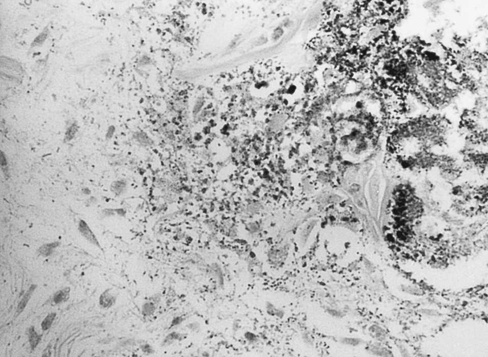 Mionecrosis de la extremidad inferior por Clostridium septicum en ...