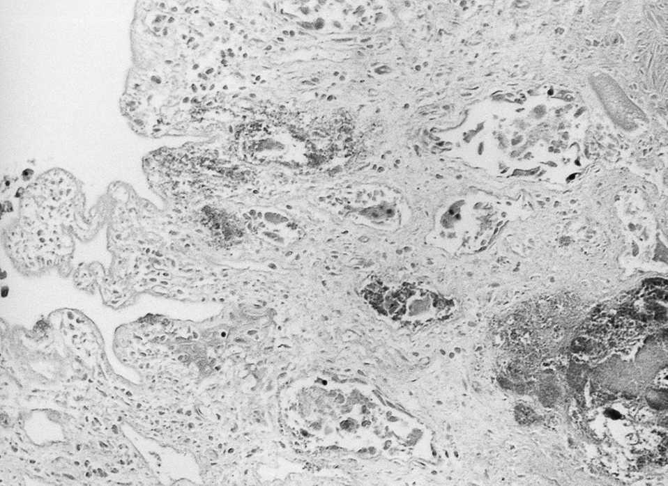 Mionecrosis de la extremidad inferior por Clostridium septicum en ...
