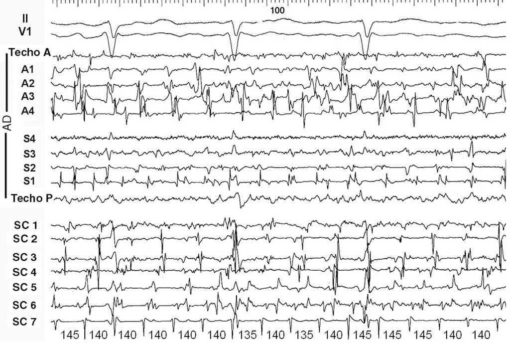 What Exactly Is Atrial Fibrillation and How Do We Diagnose it ...