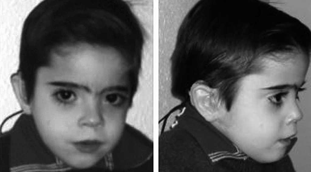 Deleción subtelomérica 9qter: definición del síndrome y origen parental ...