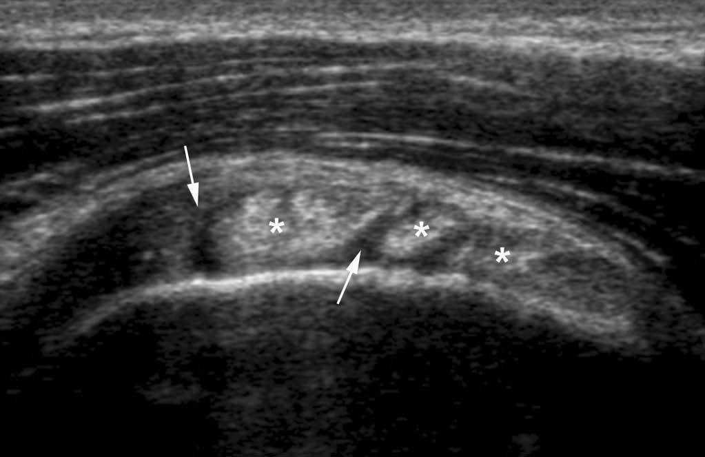 Ecografía tendinosa: de la imagen a la patología | Radiología