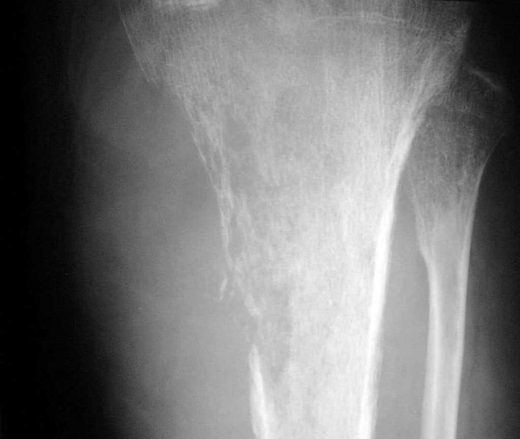 Características radiológicas del fibrohistiocitoma maligno del hueso ...