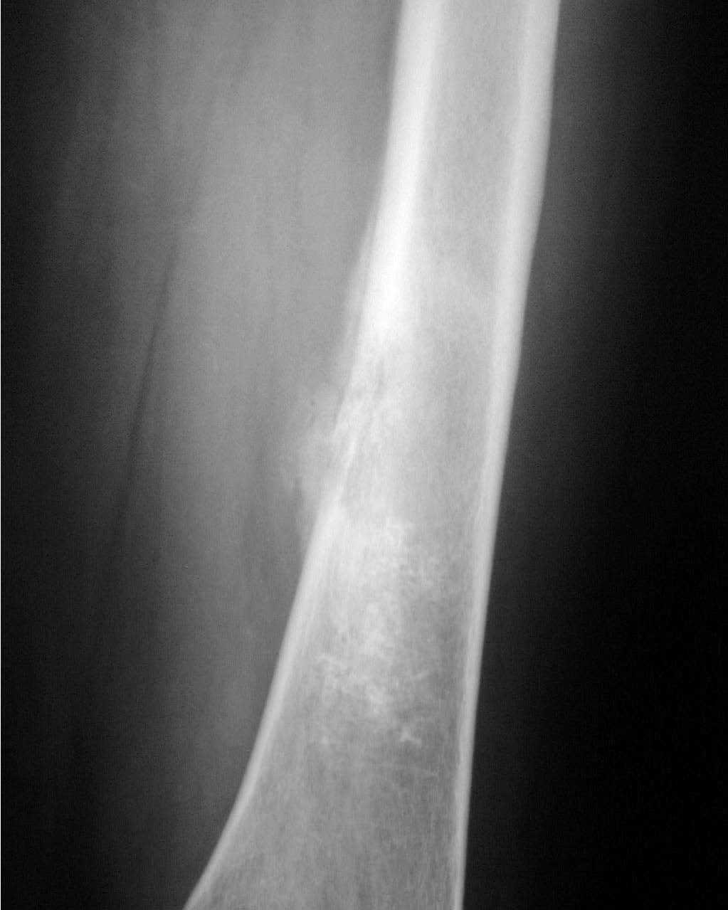 Características radiológicas del fibrohistiocitoma maligno del hueso ...