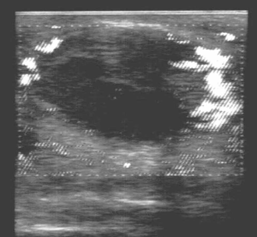 Ecografía doppler del traumatismo escrotal | Radiología