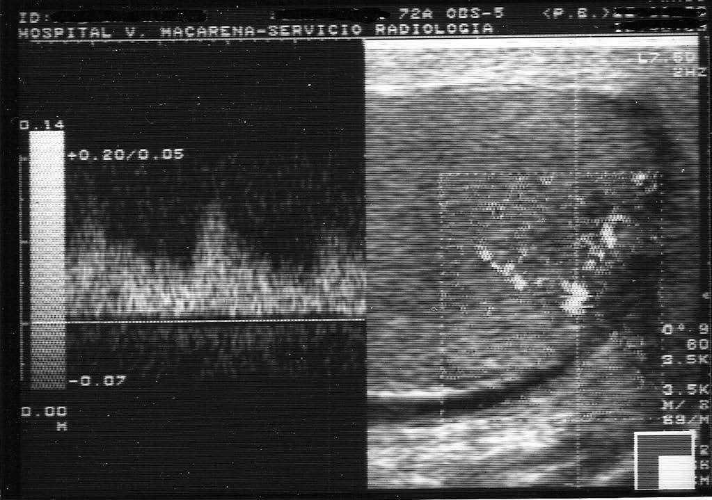 Ecografía doppler del traumatismo escrotal | Radiología