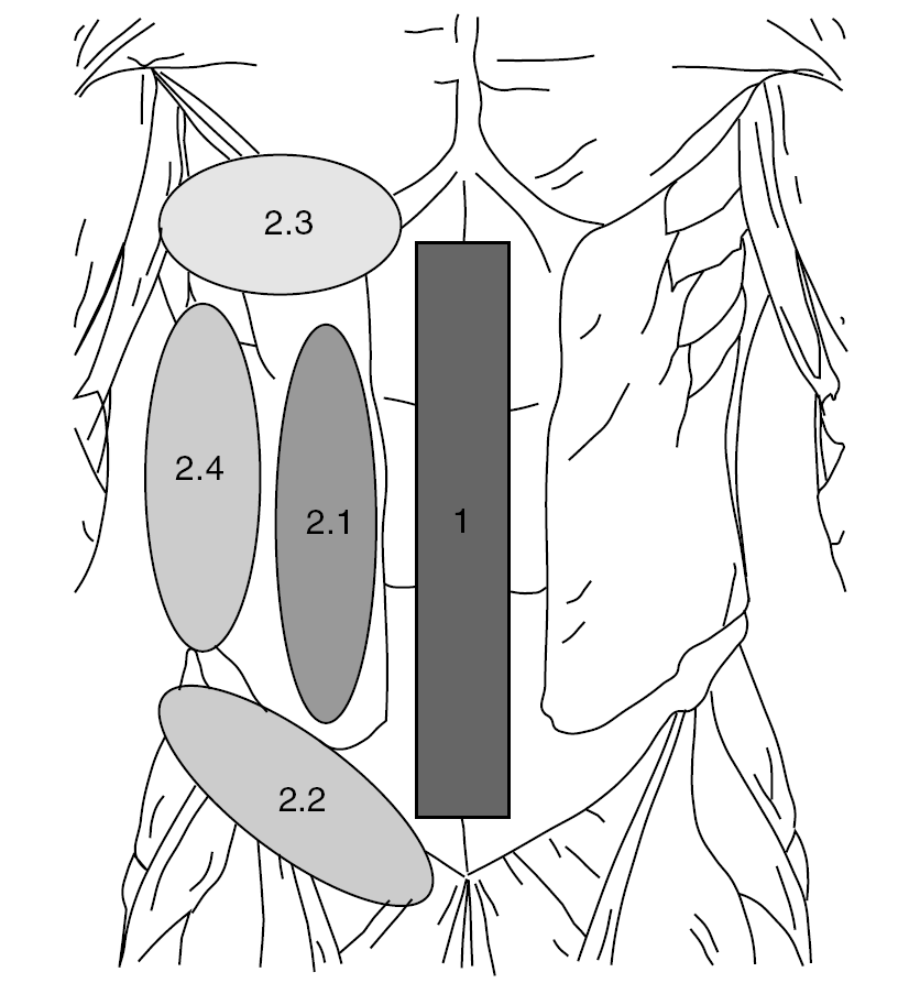 Tratamiento de la eventración no medial: experiencia de una unidad de ...