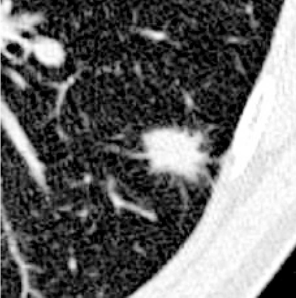 Detección y caracterización del nódulo pulmonar por tomografía ...