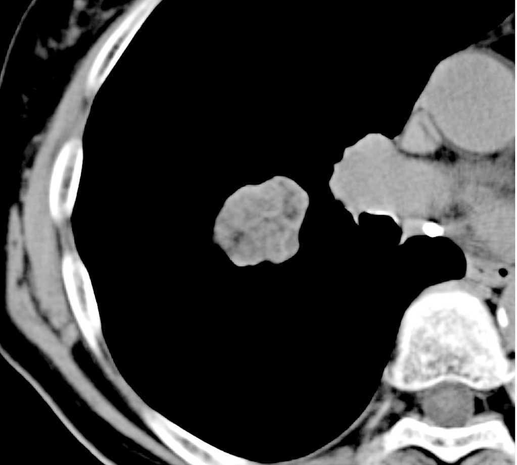 Detección y caracterización del nódulo pulmonar por tomografía ...