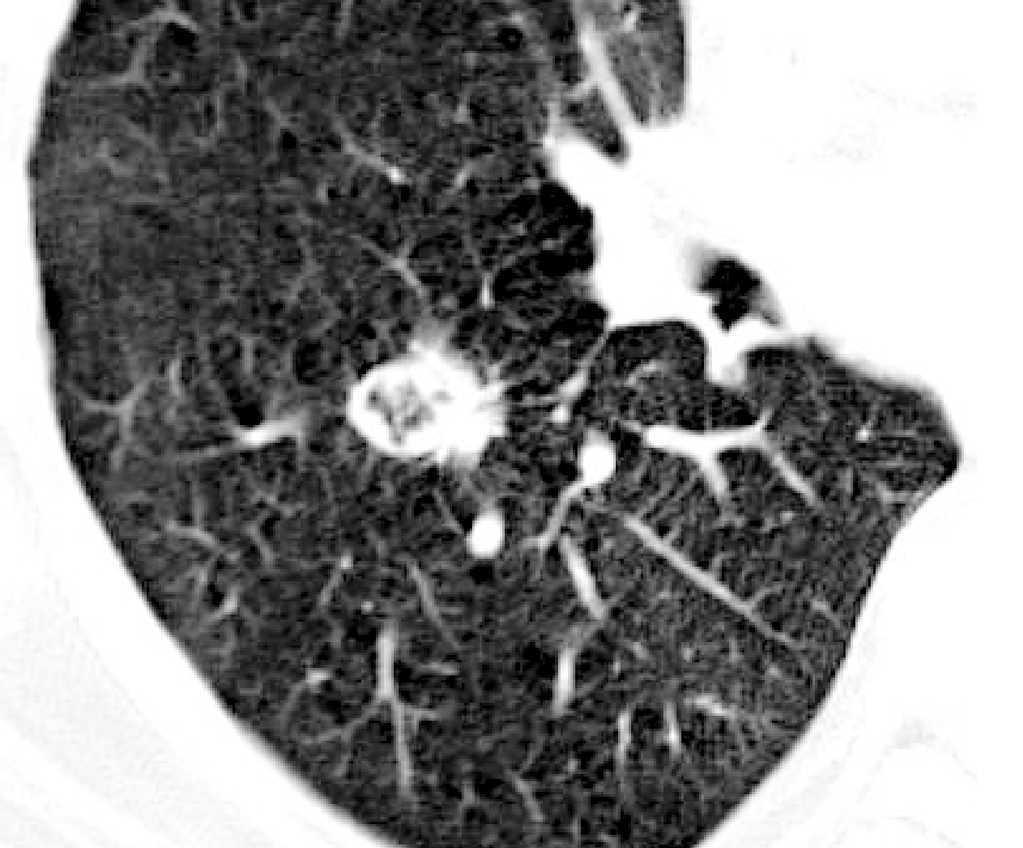Detección y caracterización del nódulo pulmonar por tomografía ...